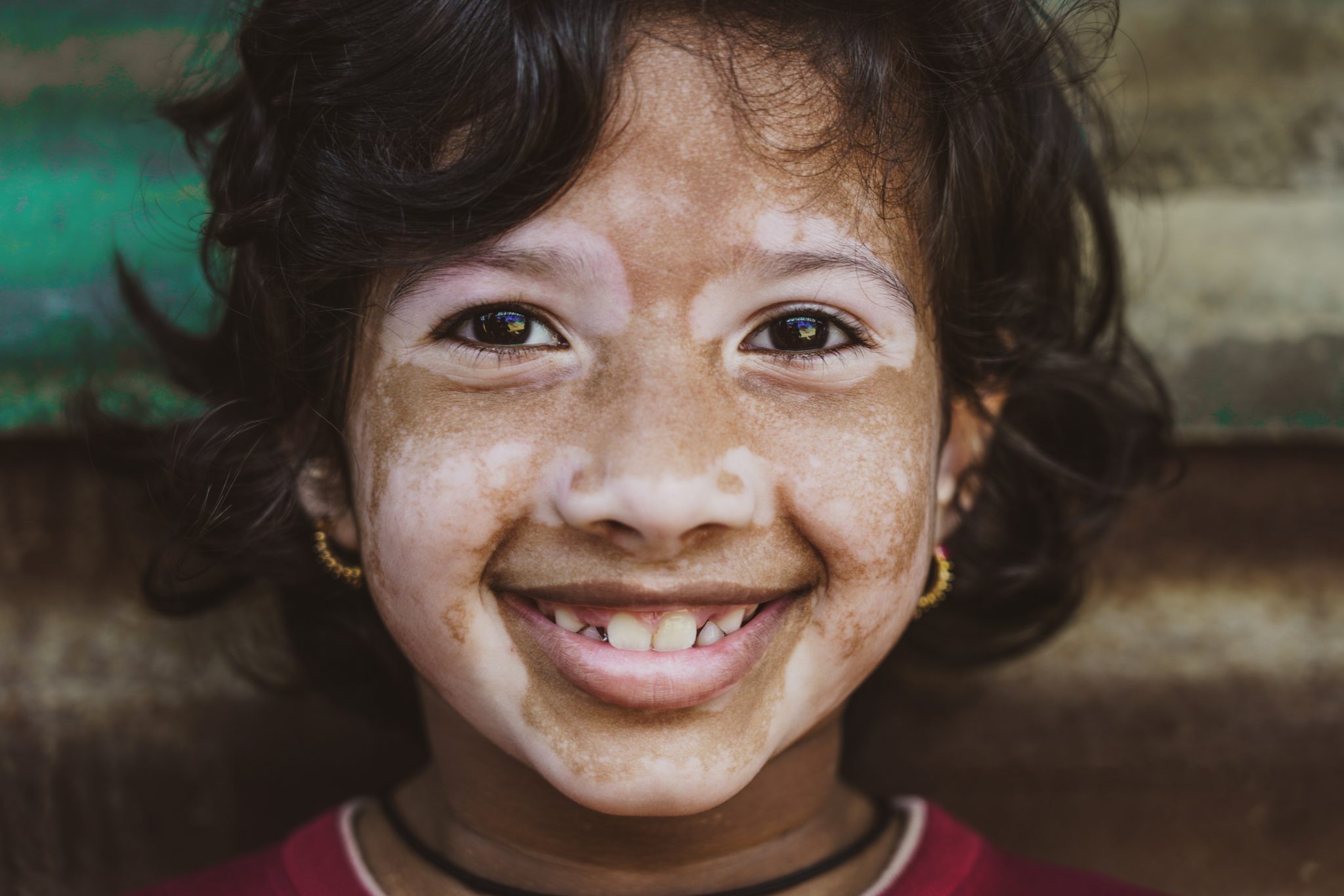 Vitiligo in Children: A Review of Conventional Treatments - VIPOC