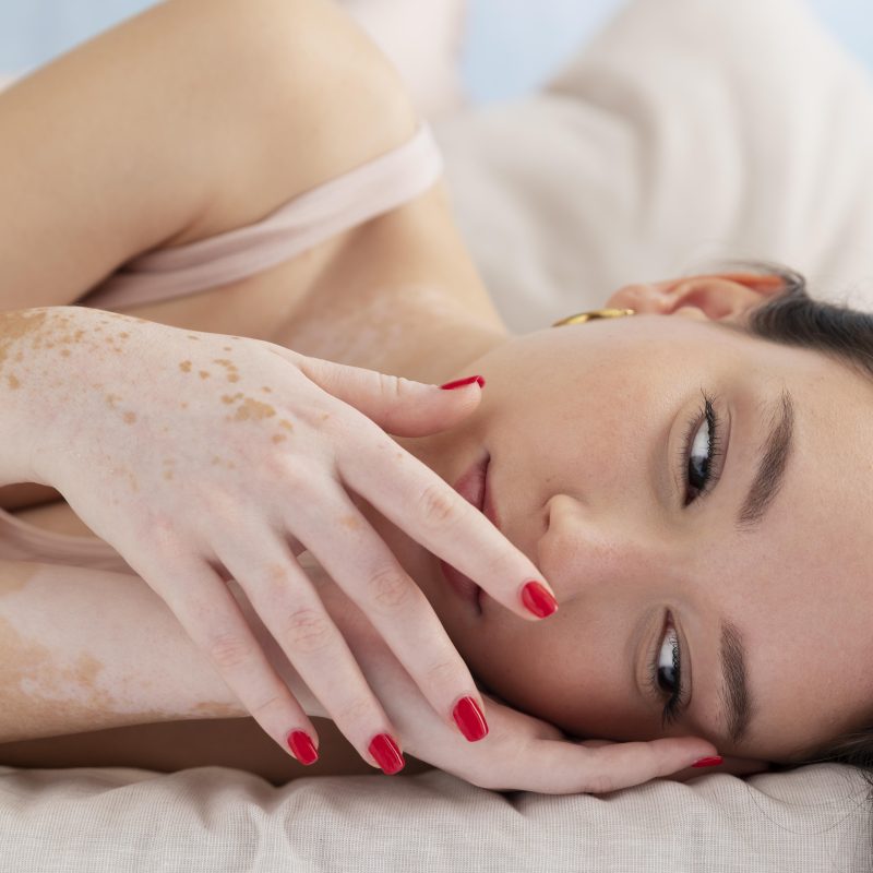 The History of Vitiligo Treatments - VIPOC